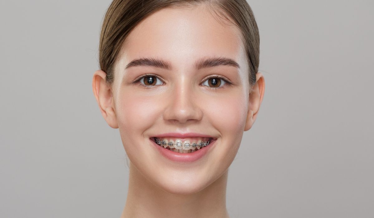 Can Braces Rust? + Common Myths About Metal Braces