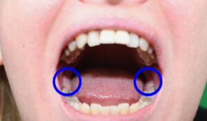 What Causes Wisdom Tooth Pain? - CavitiesGetAround