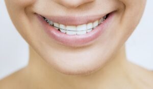 Flossing With A Permanent Retainer: Here's How To Do It